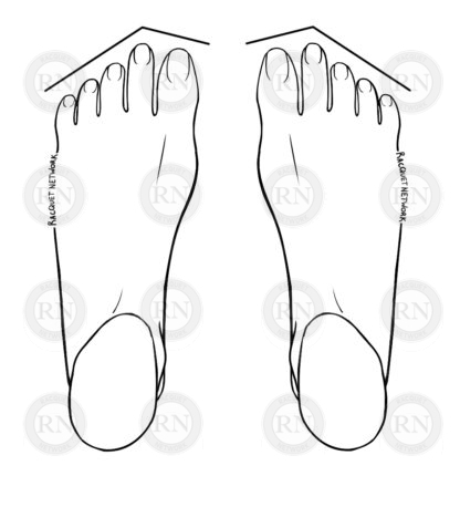 Morton's Toe (Greek) Toe Line | Expert Advice | Canada